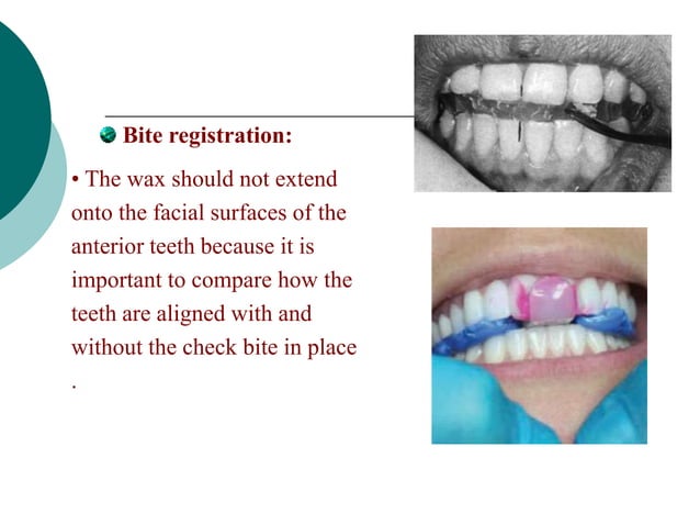 Use and abuse of bite splint. | PPT