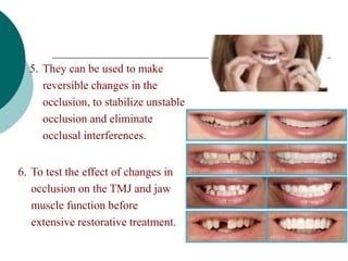 Use and abuse of bite splint. | PPT