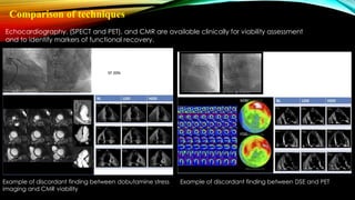 Usefulness of multimodality imaging for myocardial viability | PPT
