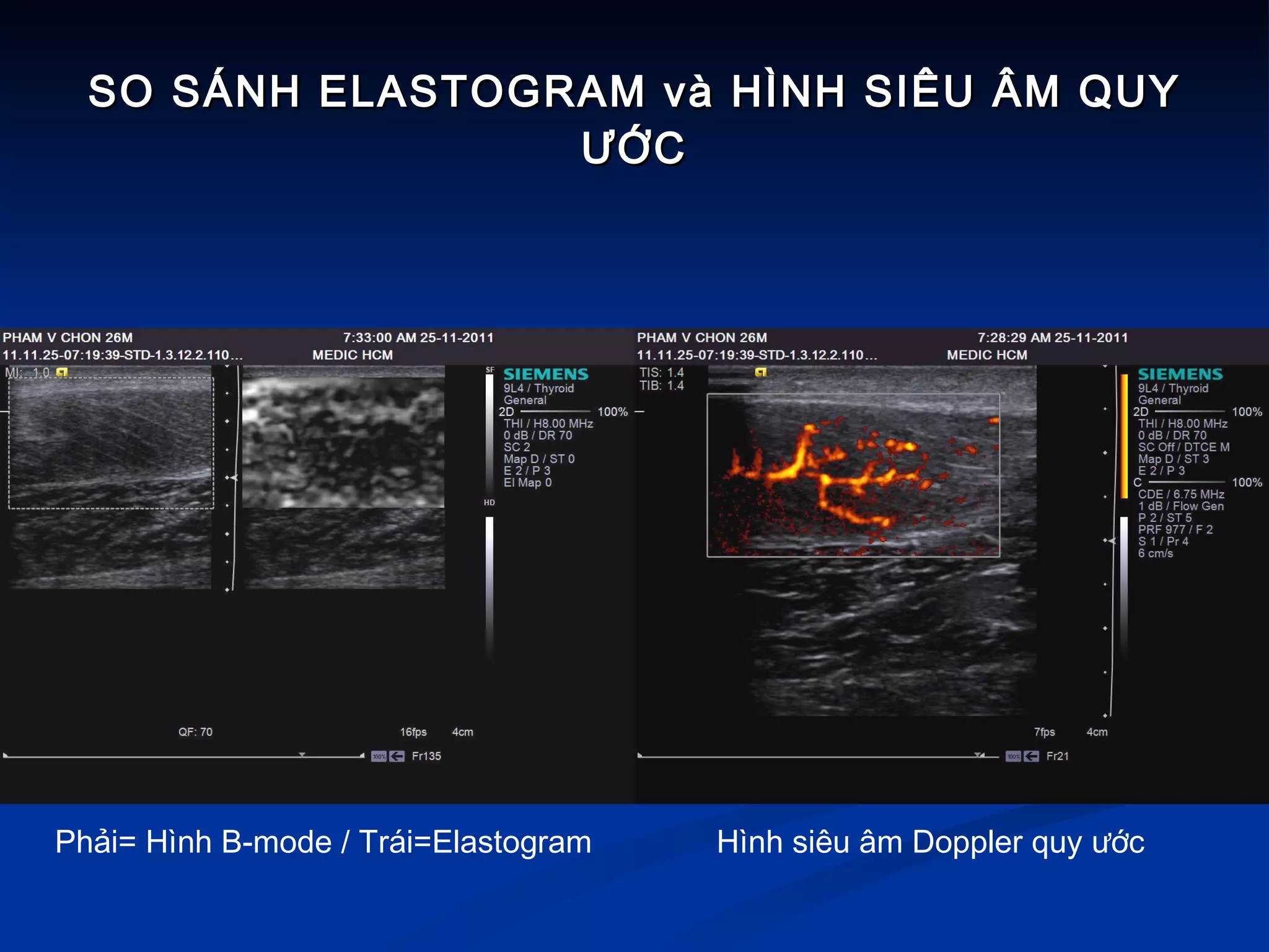 Ultrasound Elastography Medic VN | PPT