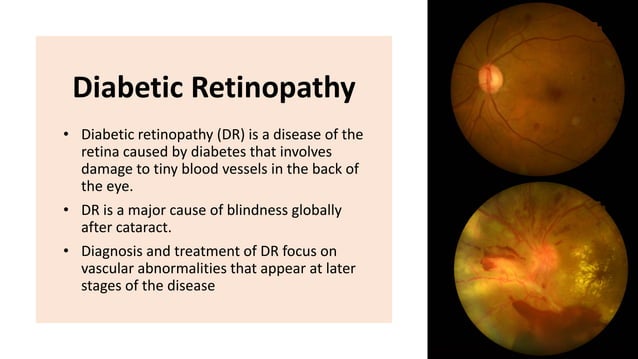 USE OF ARTIFICIAL INTELLIGENCE (DR.MATA SYSTEM) FOR THE DETECTION AND INTERVENTION OF DIABETIC ...