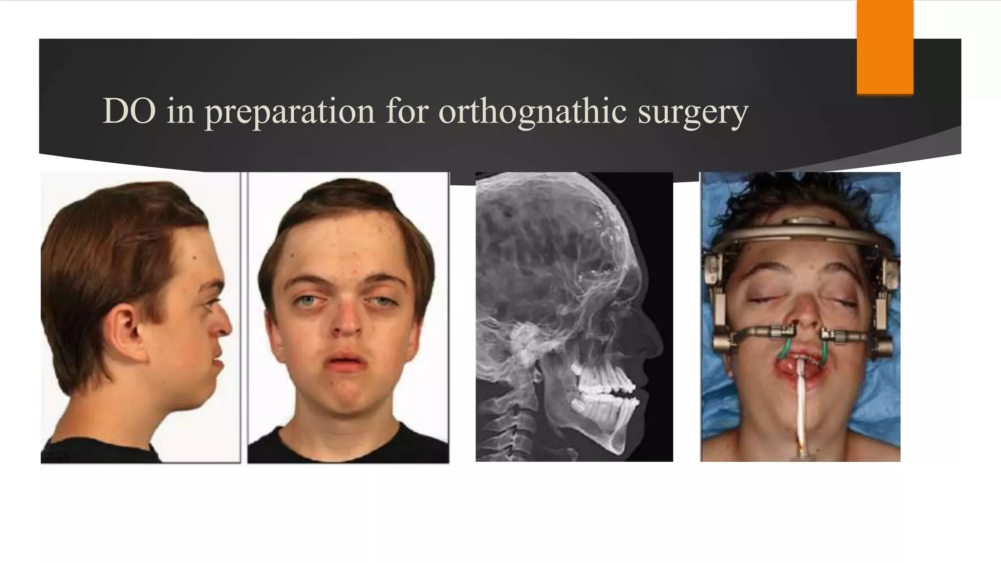 Use of distraction osteogenesis in orthognathic surgery | PPTX