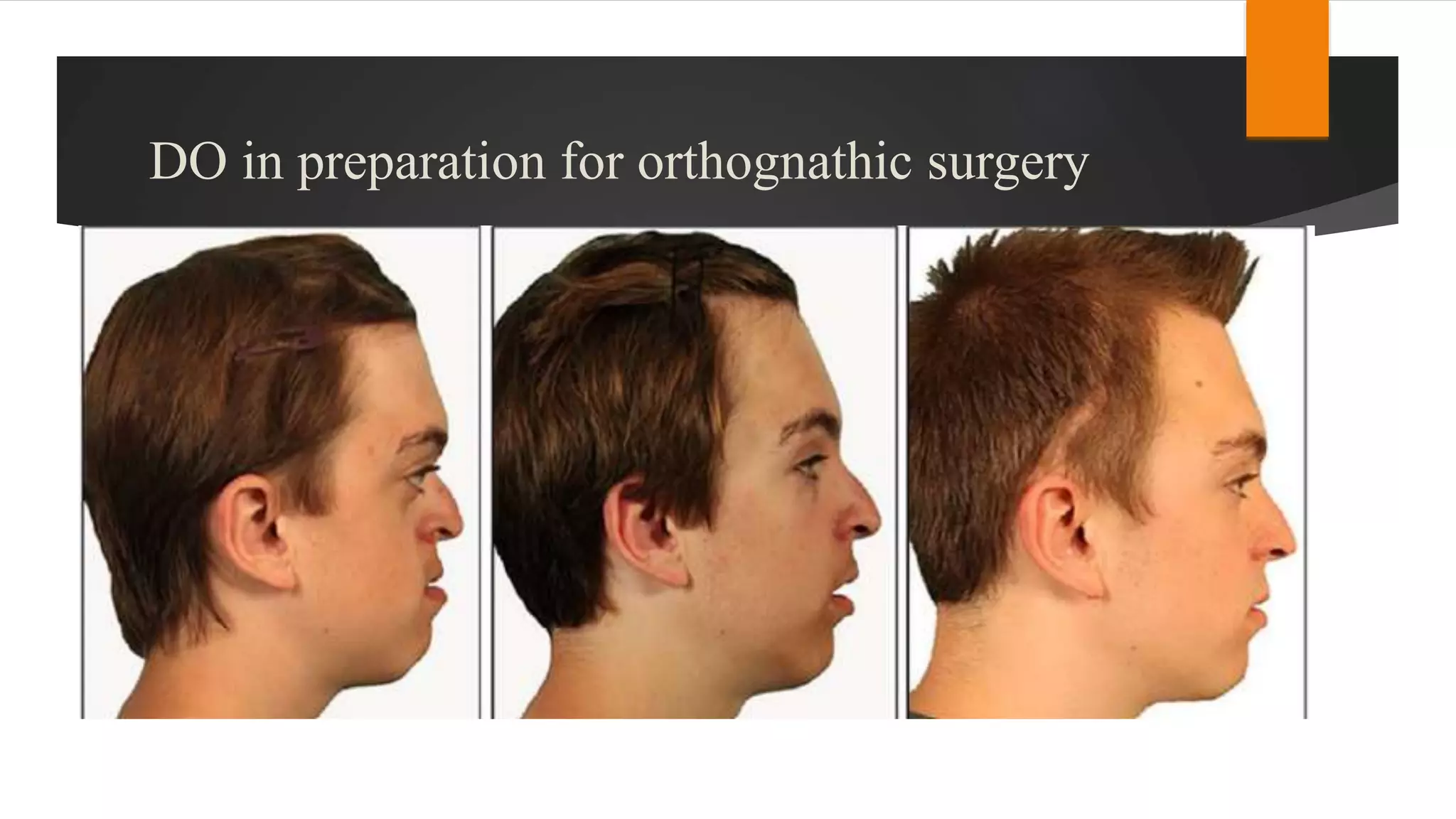 Use of distraction osteogenesis in orthognathic surgery | PPTX