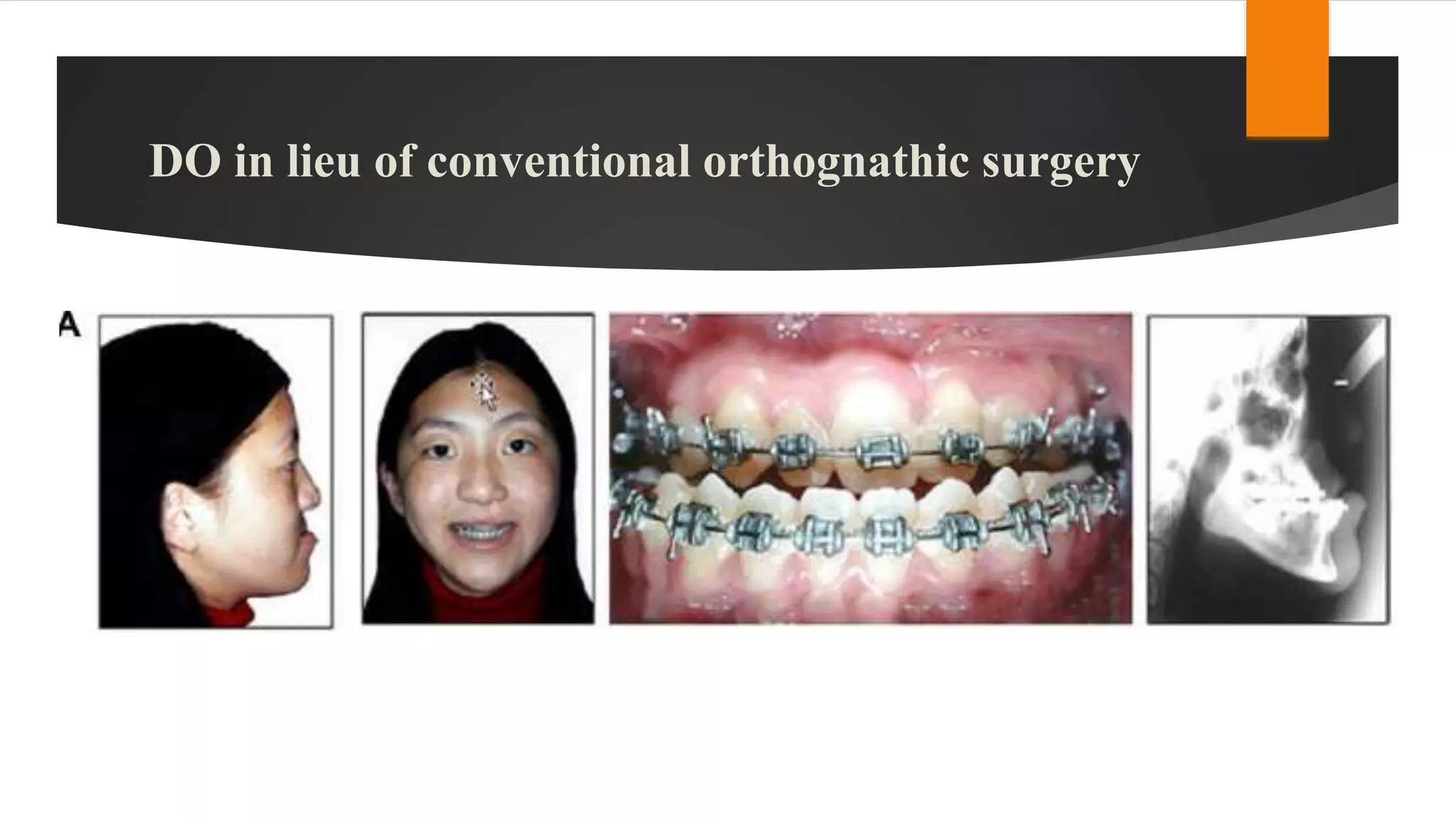 Use of distraction osteogenesis in orthognathic surgery | PPTX