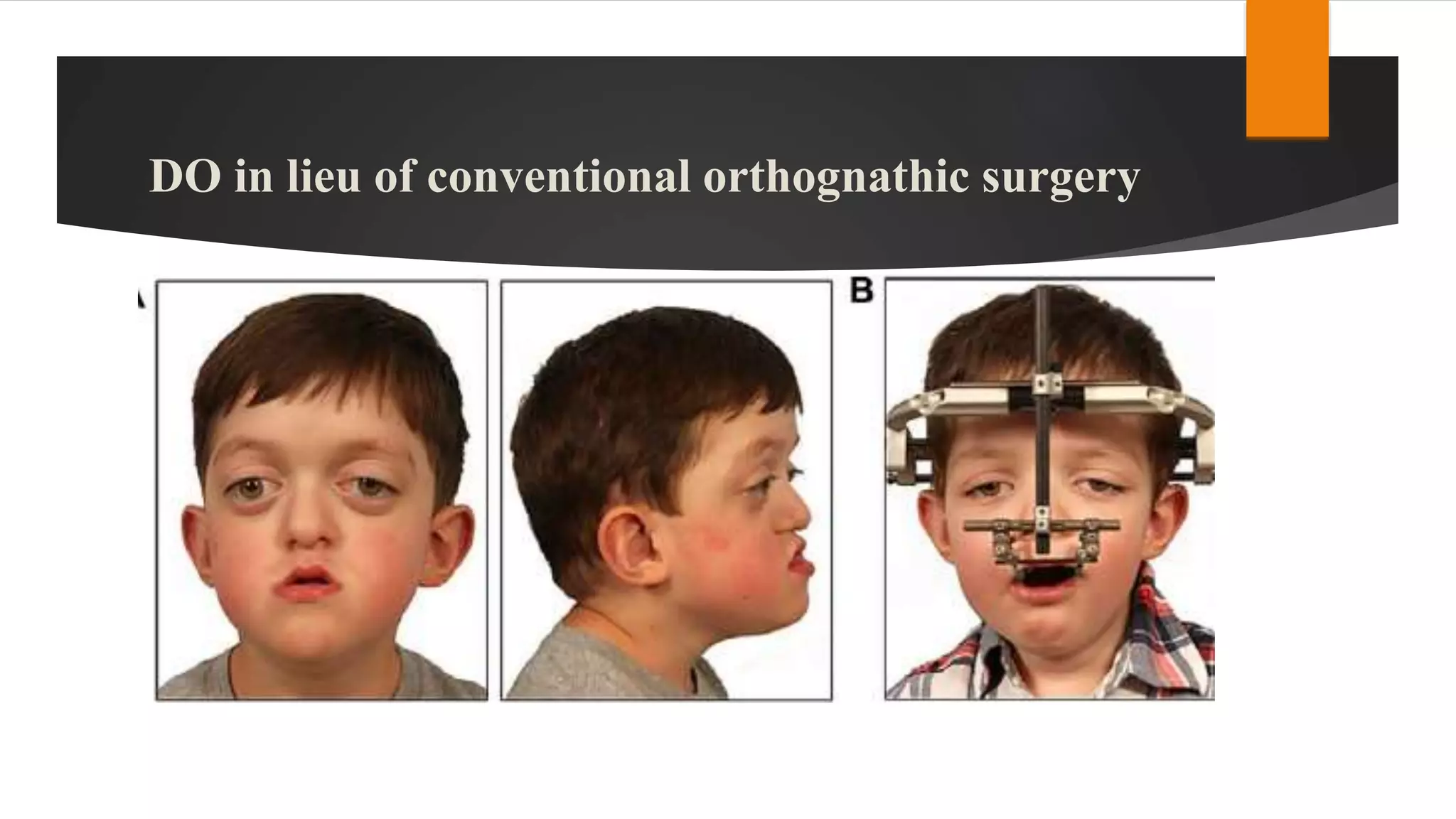 Use of distraction osteogenesis in orthognathic surgery | PPTX
