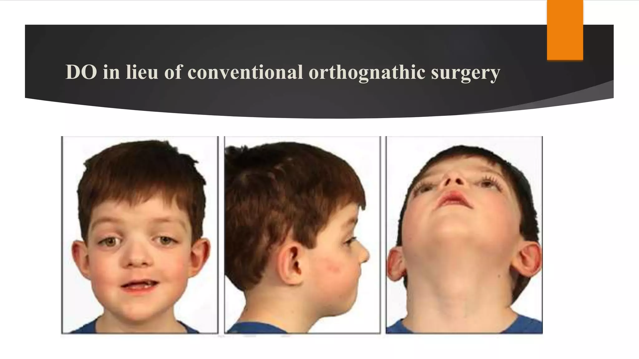 Use of distraction osteogenesis in orthognathic surgery | PPTX