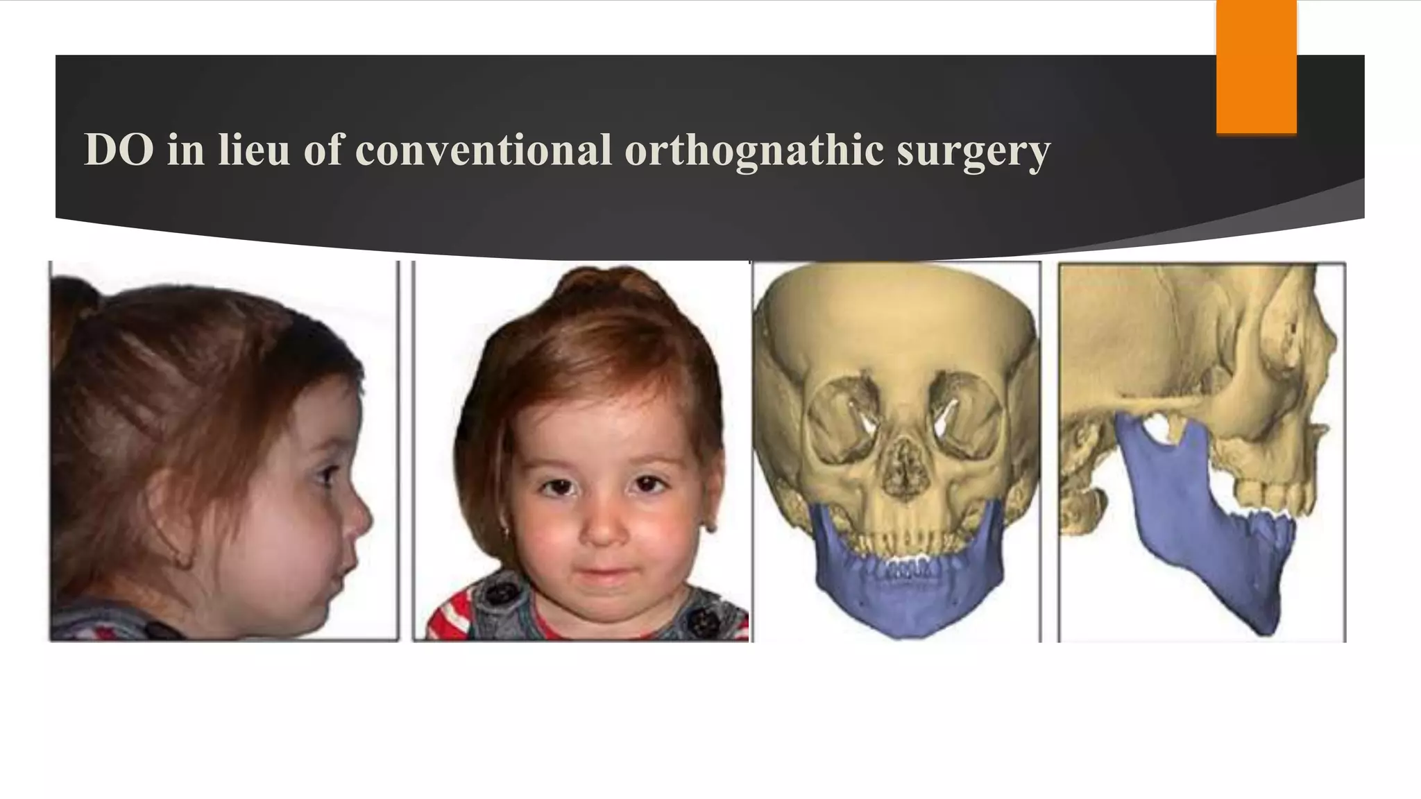 Use of distraction osteogenesis in orthognathic surgery | PPTX
