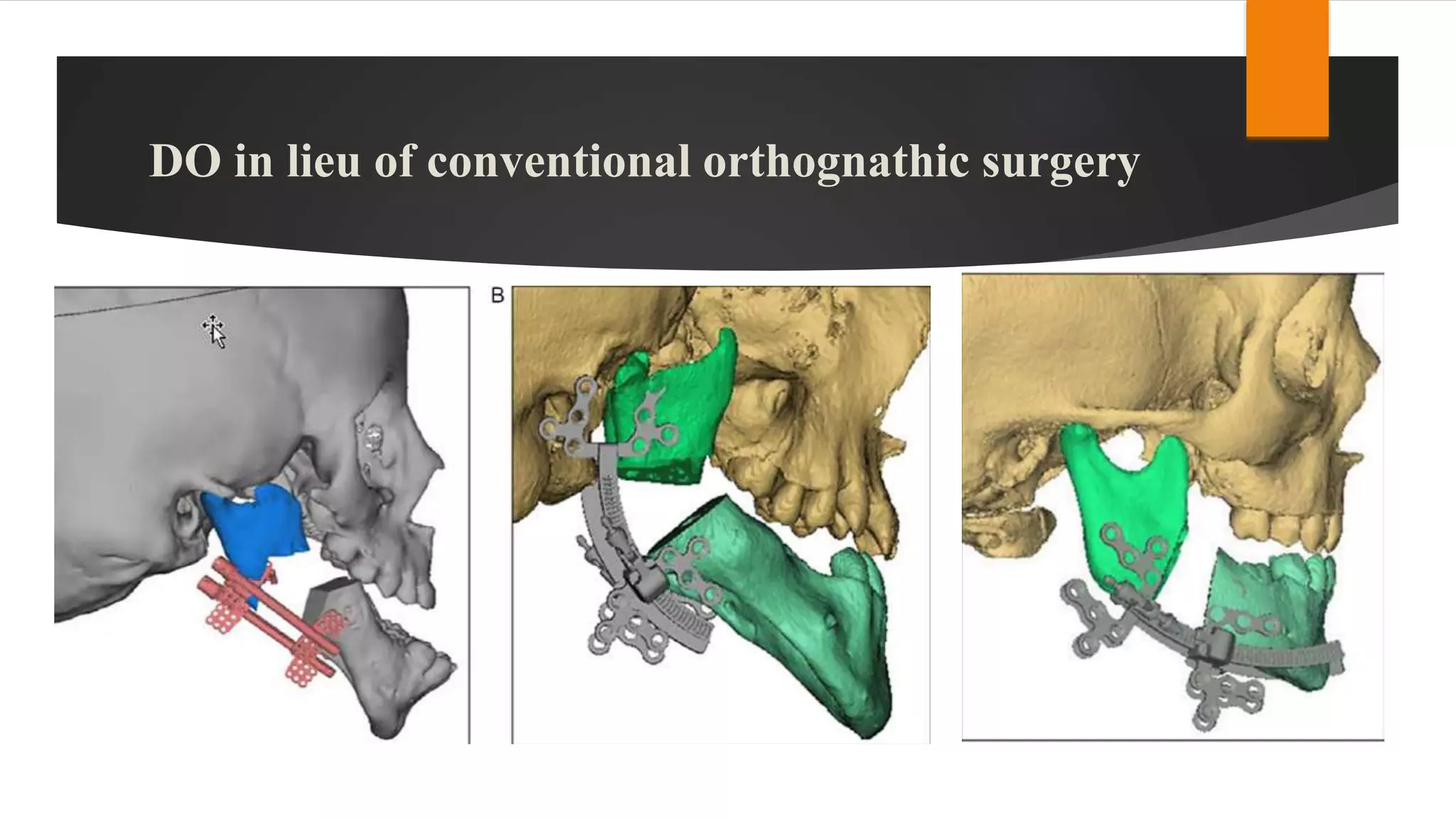 Use of distraction osteogenesis in orthognathic surgery | PPTX