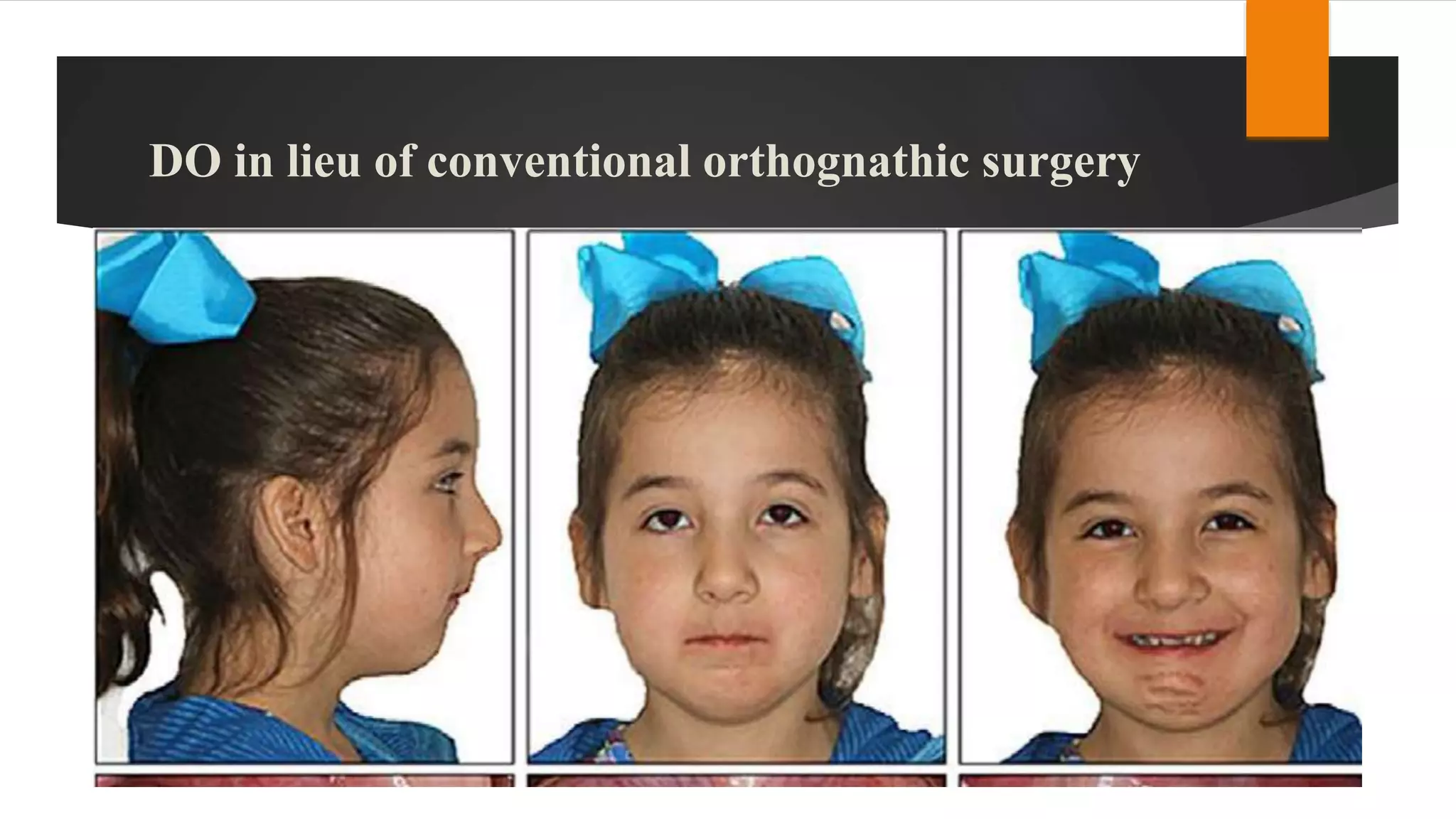 Use of distraction osteogenesis in orthognathic surgery | PPTX