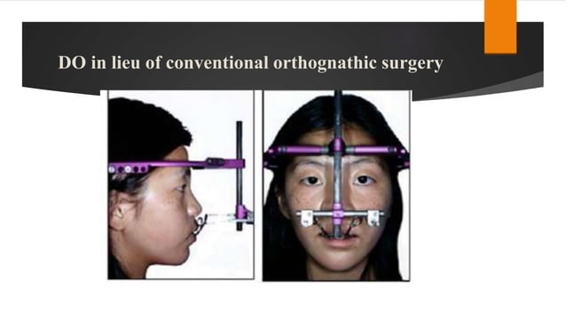 Use of distraction osteogenesis in orthognathic surgery | PPT