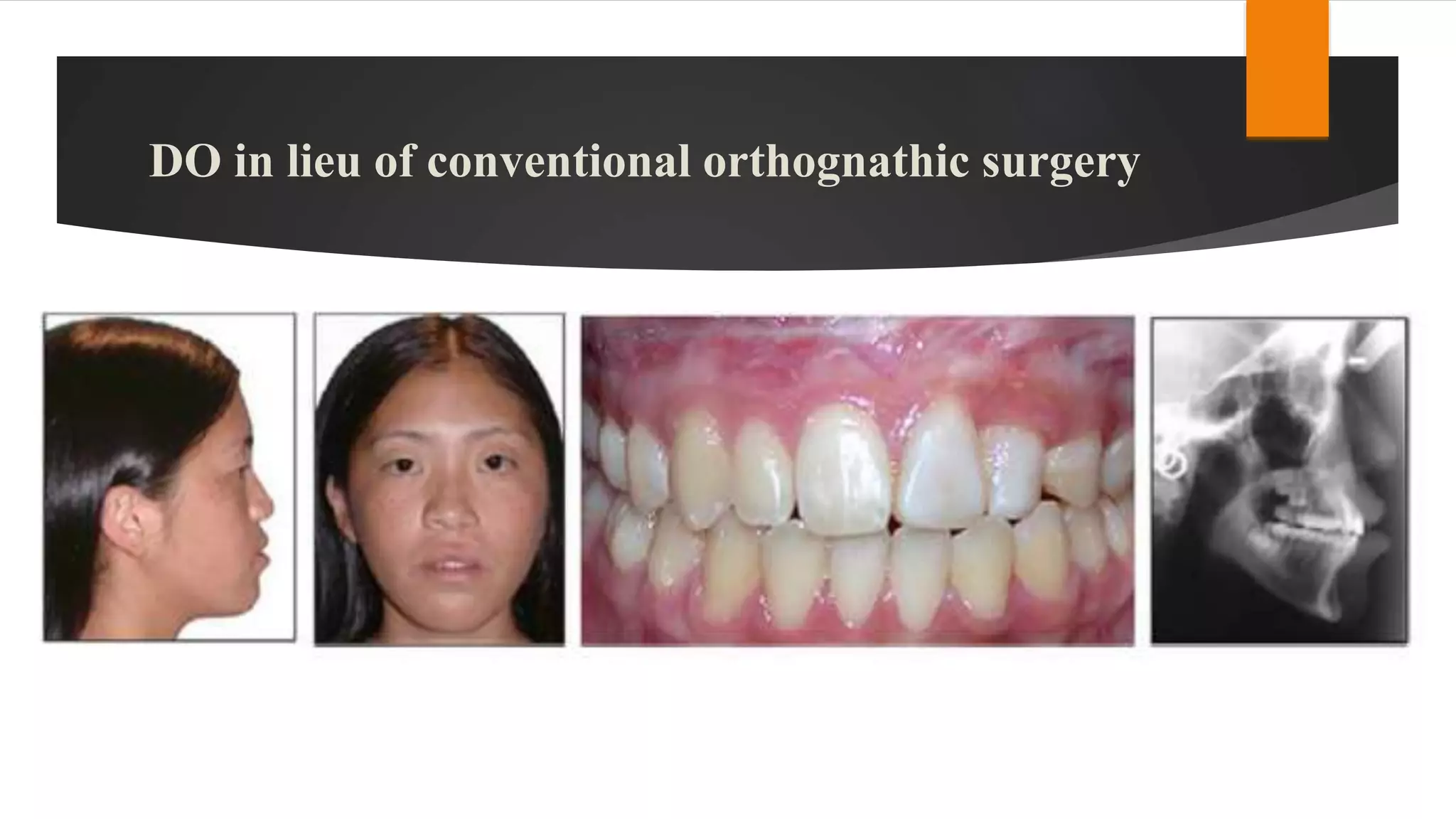 Use of distraction osteogenesis in orthognathic surgery | PPTX