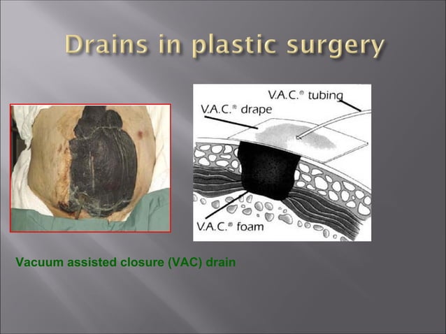 Use of drains in gastrointestinal surgery
