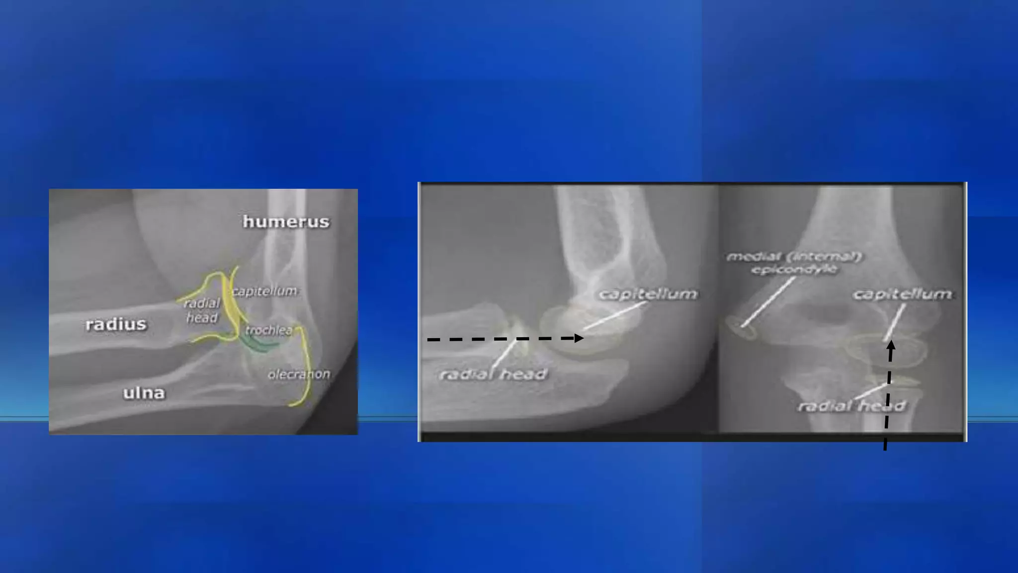 Use of elastic nail techniques in the paediatric radial fracture ,Dr ...