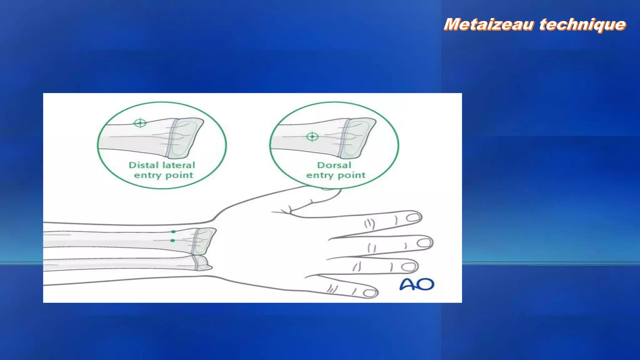 Use of elastic nail techniques in the paediatric radial fracture ,Dr ...