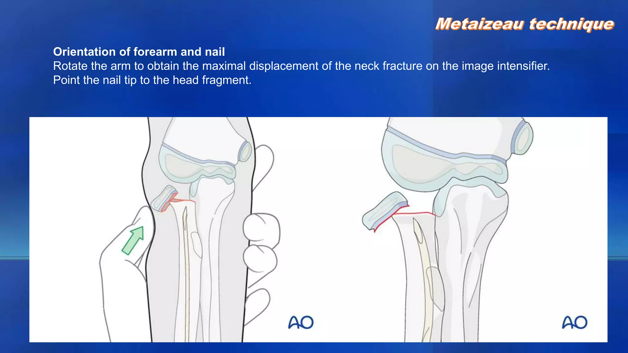 Use of elastic nail techniques in the paediatric radial fracture ,Dr ...