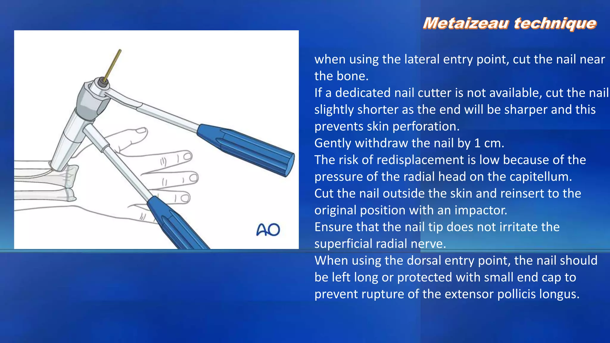 Use of elastic nail techniques in the paediatric radial fracture ,Dr ...