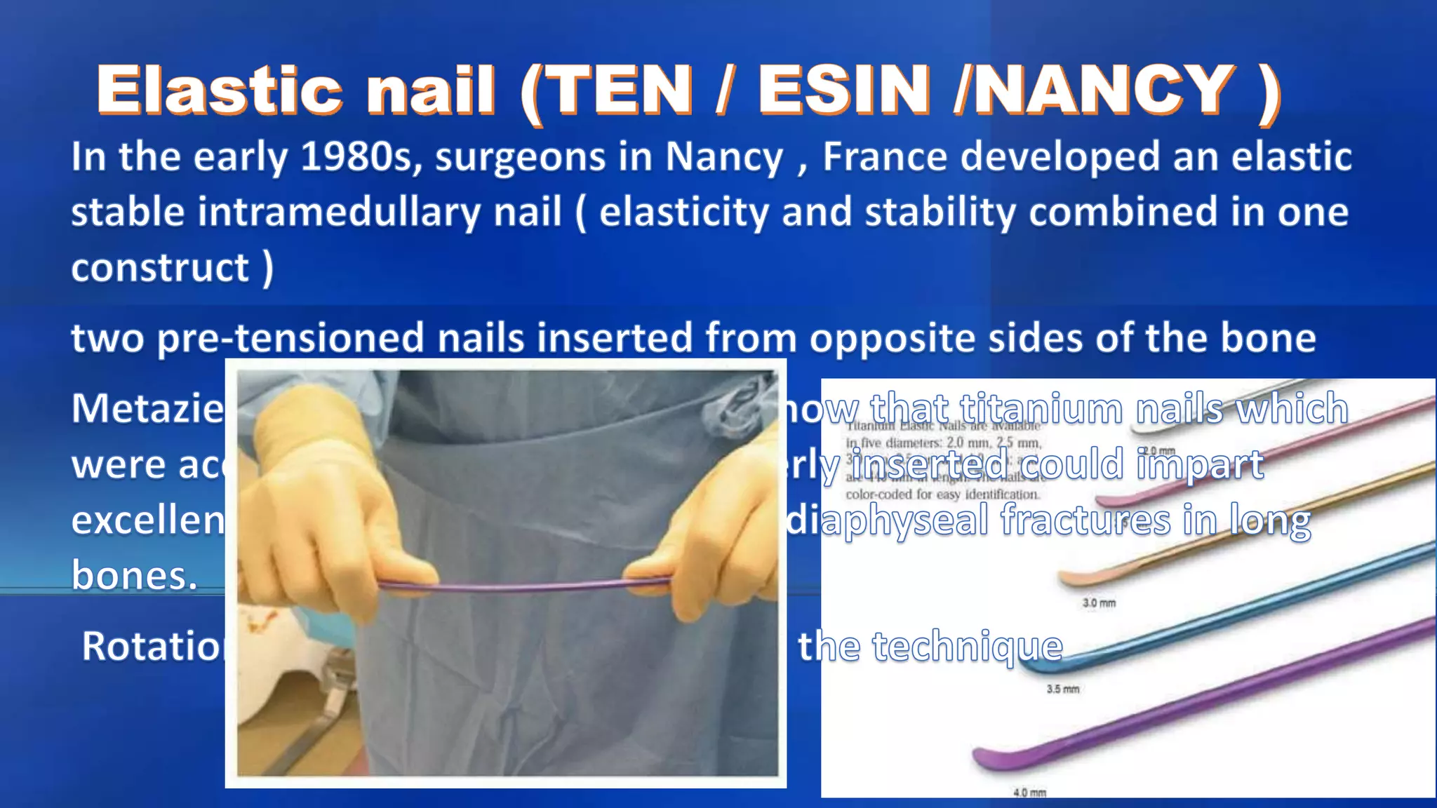 Use of elastic nail techniques in the paediatric radial fracture ,Dr ...