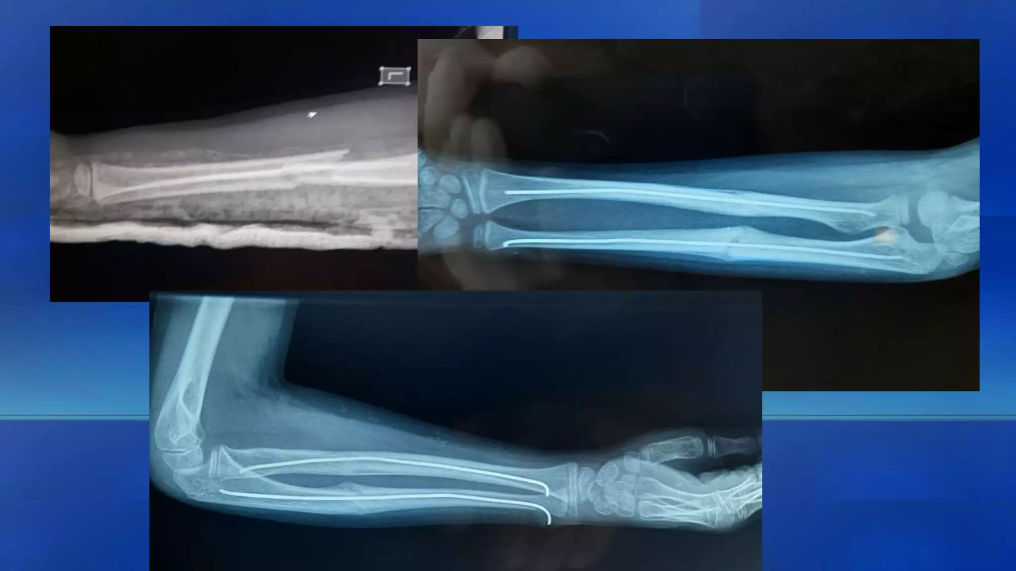 Use of elastic nail techniques in the paediatric radial fracture ,Dr ...