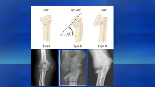 Use of elastic nail techniques in the paediatric radial fracture ,Dr ...