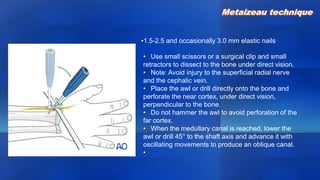 Use of elastic nail techniques in the paediatric radial fracture ,Dr ...
