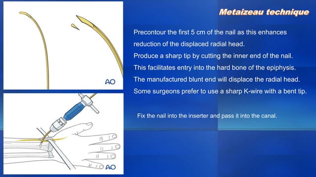 Use of elastic nail techniques in the paediatric radial fracture ,Dr ...