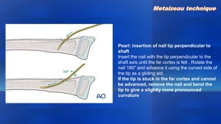 Use of elastic nail techniques in the paediatric radial fracture ,Dr ...