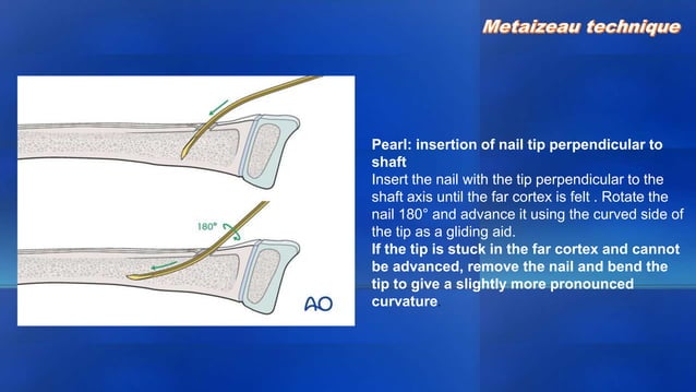 Use of elastic nail techniques in the paediatric radial fracture ,Dr ...