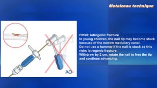 Use of elastic nail techniques in the paediatric radial fracture ,Dr ...