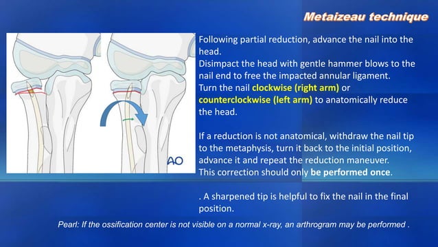 Use of elastic nail techniques in the paediatric radial fracture ,Dr ...