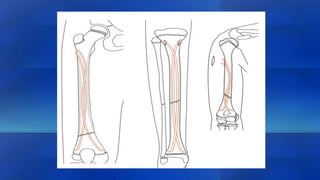 Use of elastic nail techniques in the paediatric radial fracture ,Dr ...