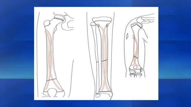 Use of elastic nail techniques in the paediatric radial fracture ,Dr ...