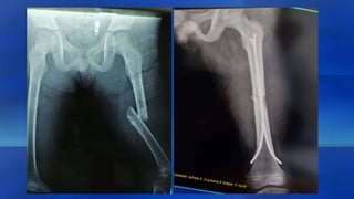 Use of elastic nail techniques in the paediatric radial fracture ,Dr ...