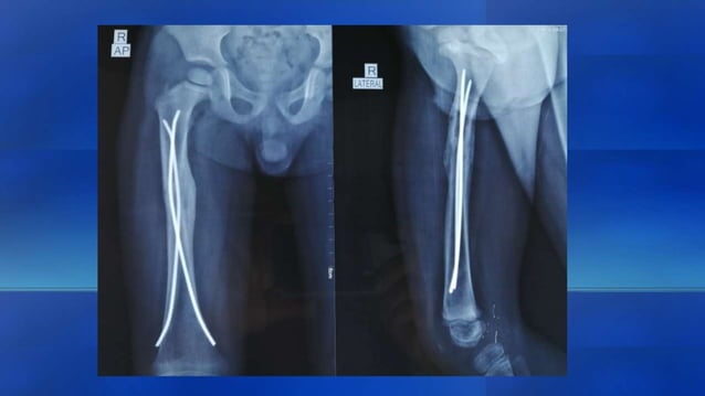 Use of elastic nail techniques in the paediatric radial fracture ,Dr ...