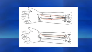 Use of elastic nail techniques in the paediatric radial fracture ,Dr ...