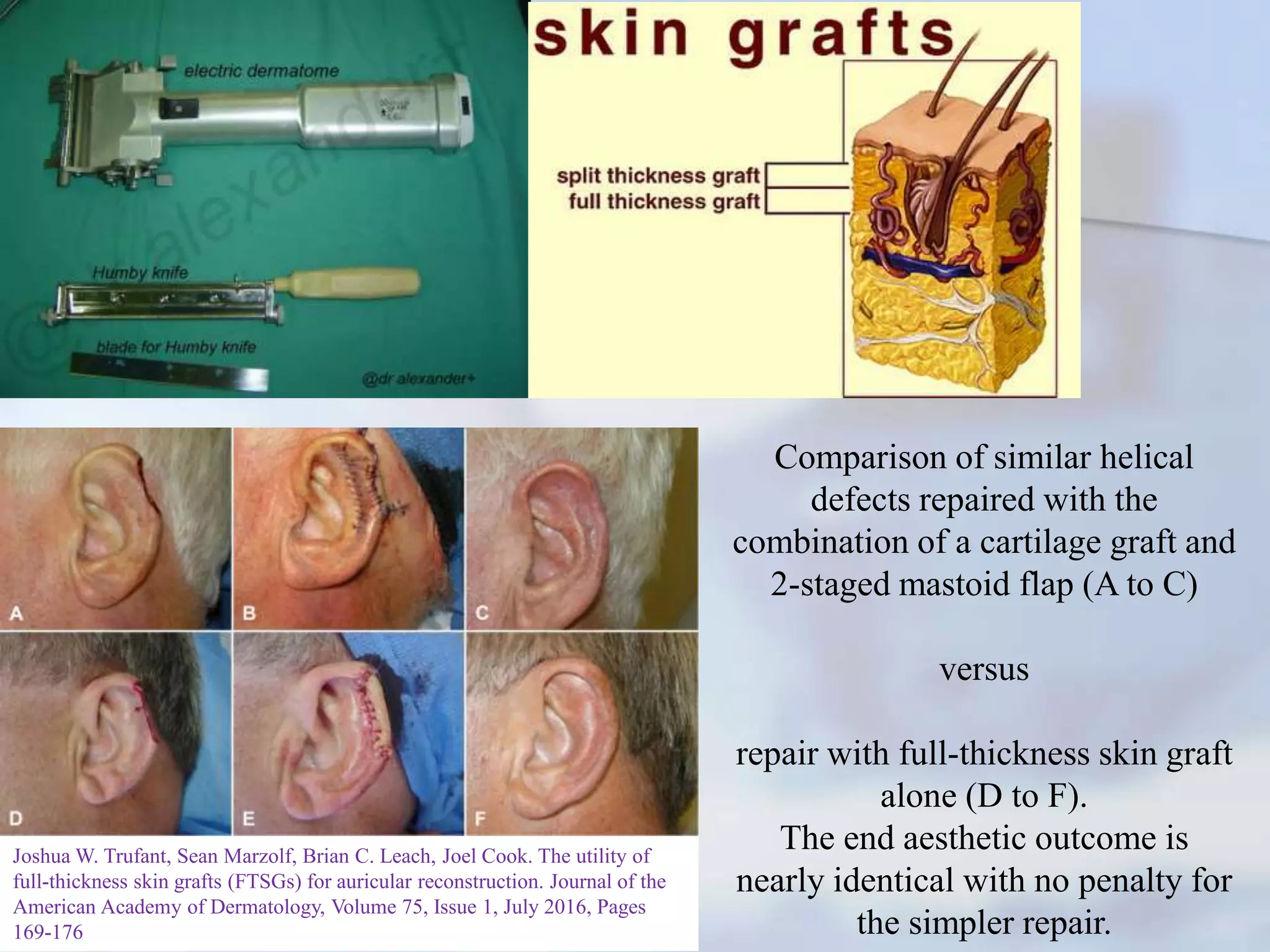 Use of grafts & alloplastic material in maxillofacial trauma | PPTX
