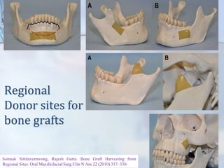 Use of grafts & alloplastic material in maxillofacial trauma | PPTX