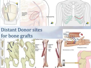Use of grafts & alloplastic material in maxillofacial trauma | PPTX
