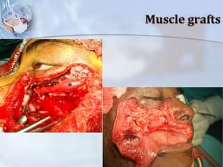 Use of grafts & alloplastic material in maxillofacial trauma | PPTX