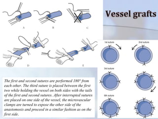 Use of grafts & alloplastic material in maxillofacial trauma | PPTX