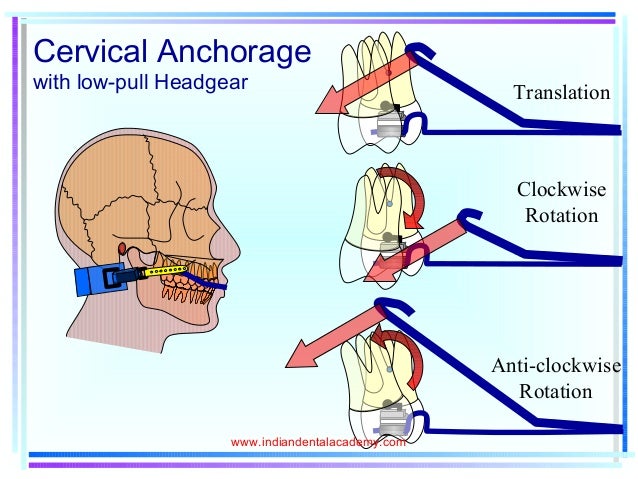 Use of head gears in day to day orthodontic practice