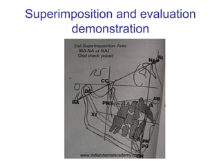 Use of superimposition areas to establish treatment design | PPT