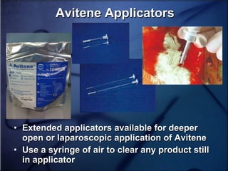 Use Of Tissue Sealants And Hemostatic Agents | PPT