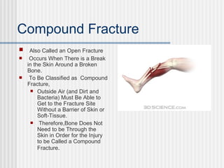 Types of Fractures | PPT