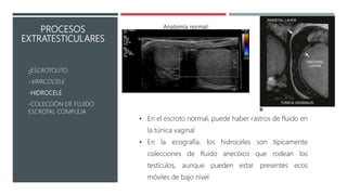 ULTRASONIDO ESCROTAL (US TESTICULAR) | PPTX