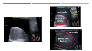 ULTRASONIDO ESCROTAL (US TESTICULAR) | PPTX