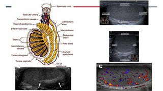 ULTRASONIDO ESCROTAL (US TESTICULAR) | PPTX
