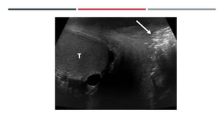 ULTRASONIDO ESCROTAL (US TESTICULAR) | PPTX
