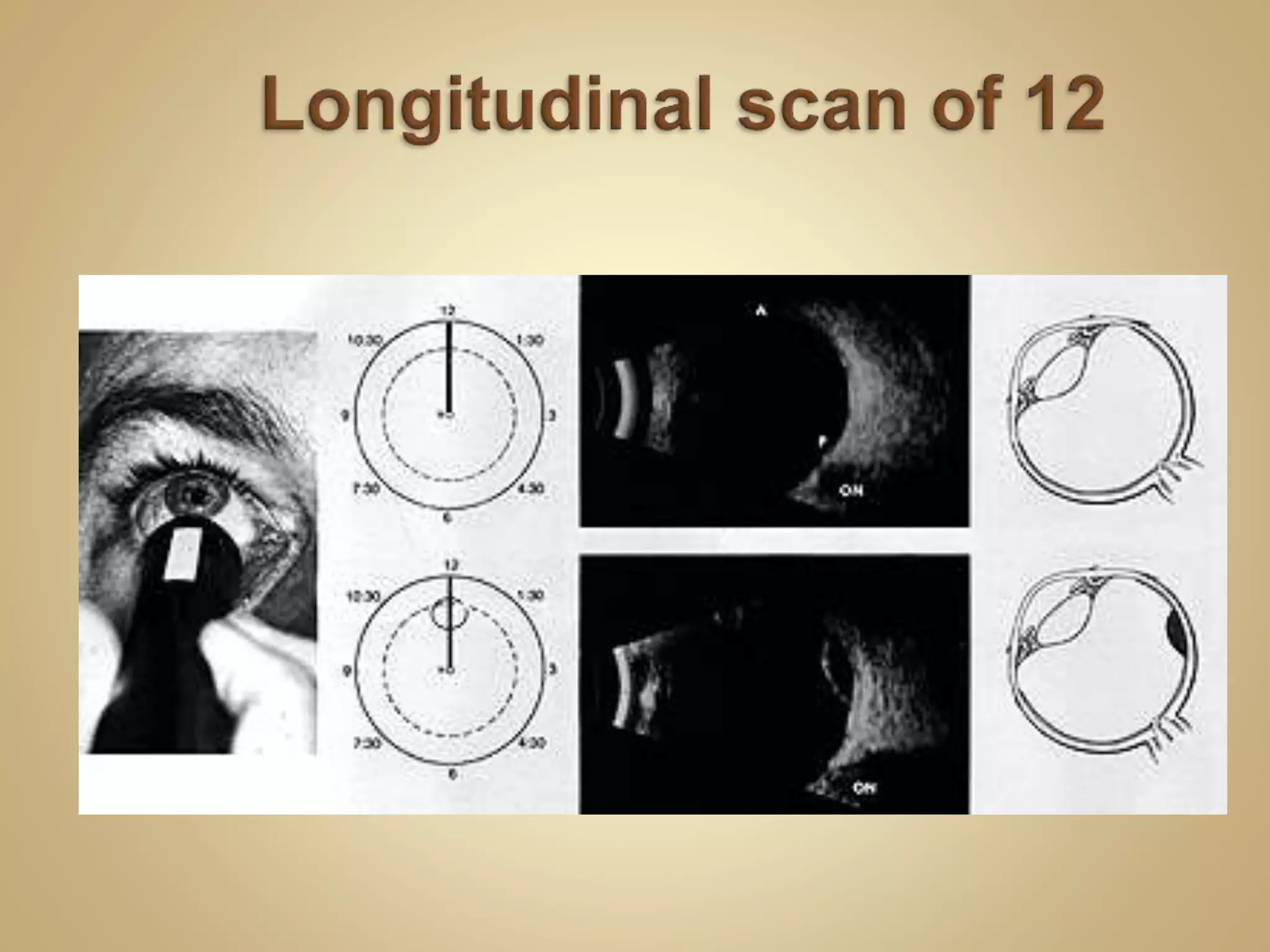 Ocular Ultrasound | PPTX