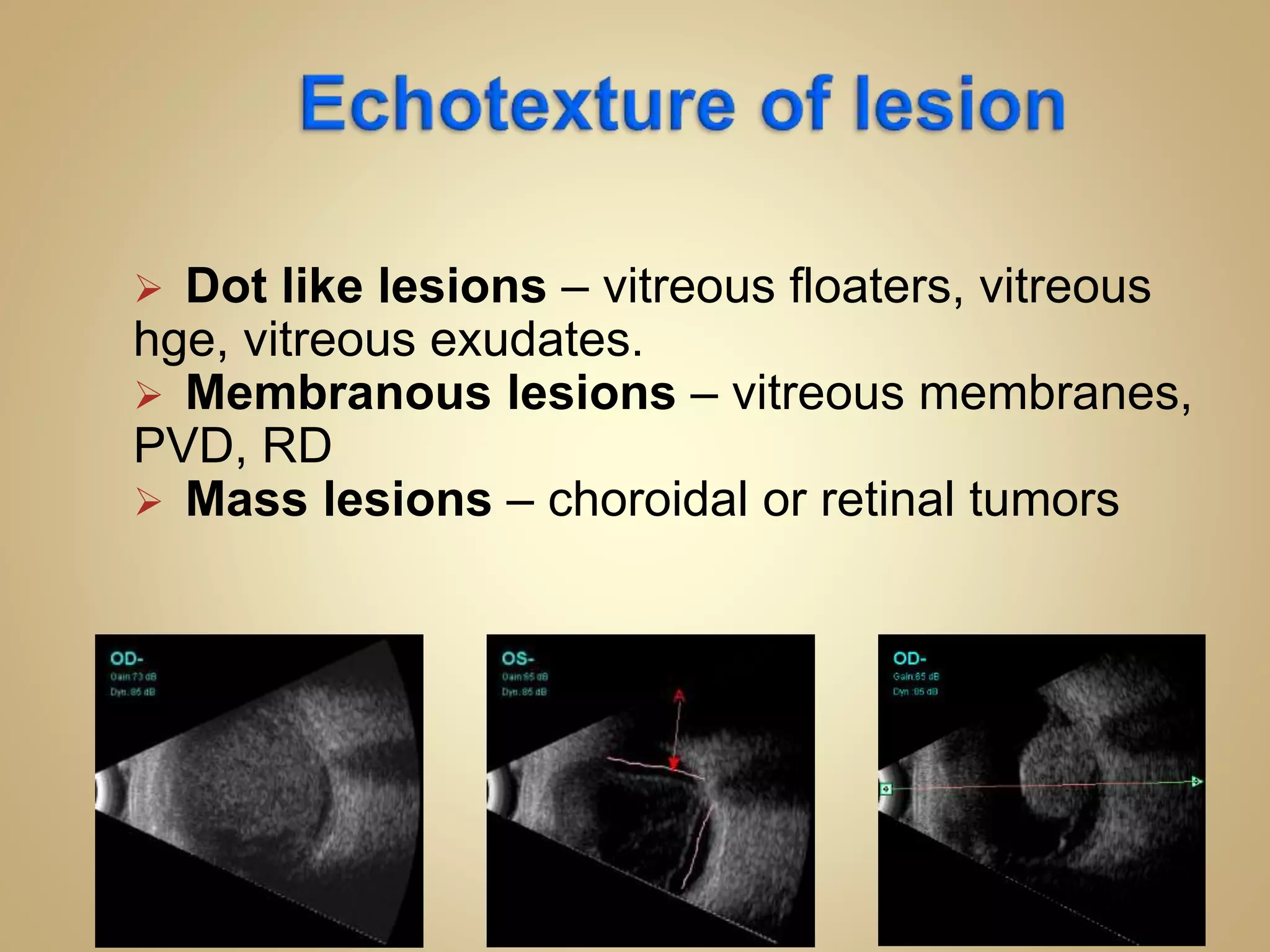 Ocular Ultrasound | PPTX