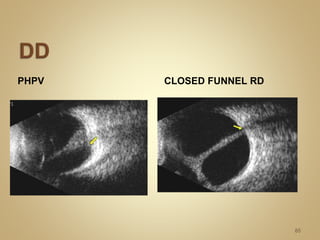 Ocular Ultrasound | PPTX